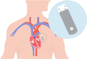 Loop Recorder Removal - Cardiologist Perth WA | Access Cardiology